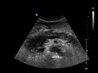 Acute pancreatitis - Knowledge @ AMBOSS