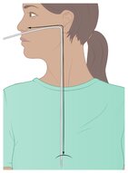 Nasogastric tube placement - Knowledge @ AMBOSS