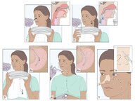 Nasogastric tube placement - Knowledge @ AMBOSS