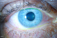 Eye pain and red eye - Knowledge @ AMBOSS