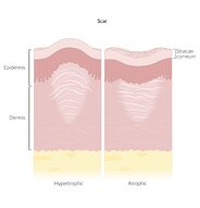 Hypertrophic scars and keloids - Knowledge @ AMBOSS