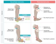 Lower extremity osteopathy - Knowledge @ AMBOSS
