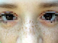 Solar lentigo