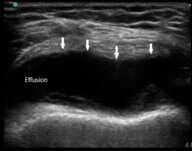 Arthrocentesis and intraarticular injection - Knowledge @ AMBOSS