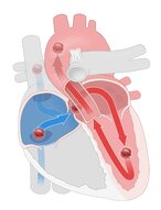 Ischemic stroke - Knowledge @ AMBOSS