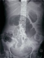 Bowel obstruction - Knowledge @ AMBOSS