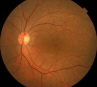 Eye pain and red eye - Knowledge @ AMBOSS