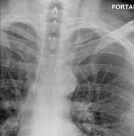 Pneumothorax - Knowledge @ AMBOSS