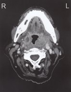 Deep neck infections - Knowledge @ AMBOSS