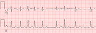 Atrial fibrillation - Knowledge @ AMBOSS