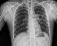 Tuberculosis - Knowledge @ AMBOSS