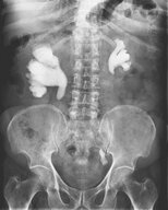 Nephrolithiasis - Knowledge @ AMBOSS