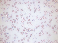 Anemia - Knowledge @ AMBOSS