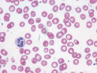 Anemia - Knowledge @ AMBOSS