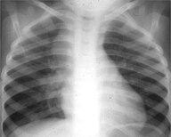 Tuberculosis - Knowledge @ AMBOSS