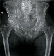 Pelvic fracture - Knowledge @ AMBOSS