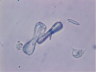 Nephrolithiasis - Knowledge @ AMBOSS