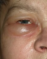 Peripheral edema - Knowledge @ AMBOSS