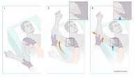Shoulder reduction - Knowledge @ AMBOSS