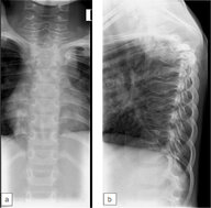 Tuberculosis - Knowledge @ AMBOSS