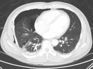 Blunt trauma - Knowledge @ AMBOSS