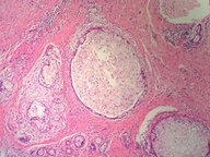 Mammary duct ectasia - Knowledge @ AMBOSS