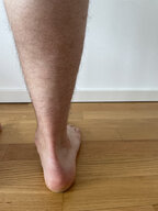 Pes planus - Knowledge @ AMBOSS