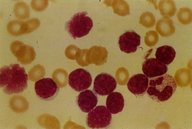 Hemolytic anemia - Knowledge @ AMBOSS