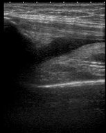 Arthrocentesis and intraarticular injection - Knowledge @ AMBOSS