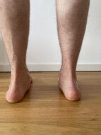 Pes planus - Knowledge @ AMBOSS