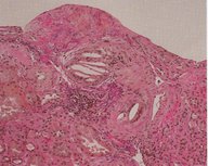 Cholesterol embolization syndrome - Knowledge @ AMBOSS