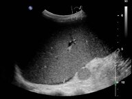 Portal vein thrombosis - Knowledge @ AMBOSS