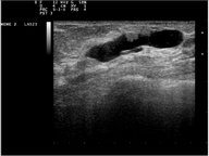 Palpable breast mass - Knowledge @ AMBOSS