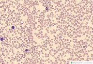 Erythrocyte morphology and hemoglobin - Knowledge @ AMBOSS
