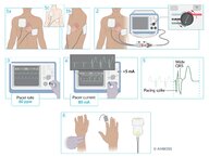 Cardiovascular drug poisoning - Knowledge @ AMBOSS