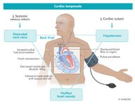 Pericardial effusion and cardiac tamponade - Knowledge @ AMBOSS