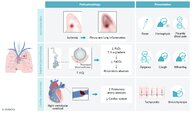 Pulmonary embolism - Knowledge @ AMBOSS