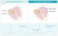 Supraventricular tachycardia - Knowledge @ AMBOSS