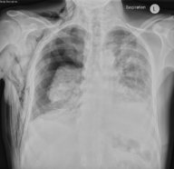 Pneumothorax - Knowledge @ AMBOSS