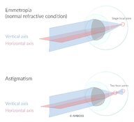 Refractive errors - Knowledge @ AMBOSS