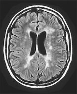 Multiple sclerosis - Knowledge @ AMBOSS