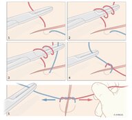 Wound closure techniques - Knowledge @ AMBOSS