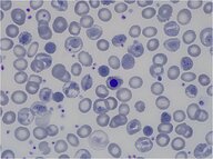 Erythrocyte morphology and hemoglobin - Knowledge @ AMBOSS