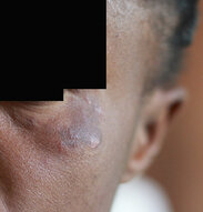 Dermatophyte infections - Knowledge @ AMBOSS