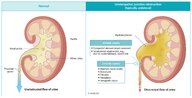 Urinary tract obstruction - Knowledge @ AMBOSS