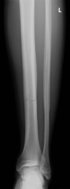 Tibial and fibular fractures - Knowledge @ AMBOSS