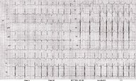 Supraventricular tachycardia - Knowledge @ AMBOSS