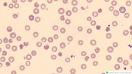 Erythrocyte morphology and hemoglobin - Knowledge @ AMBOSS