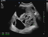Adnexal mass - Knowledge @ AMBOSS