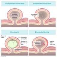 Small bowel diverticular disease - Knowledge @ AMBOSS